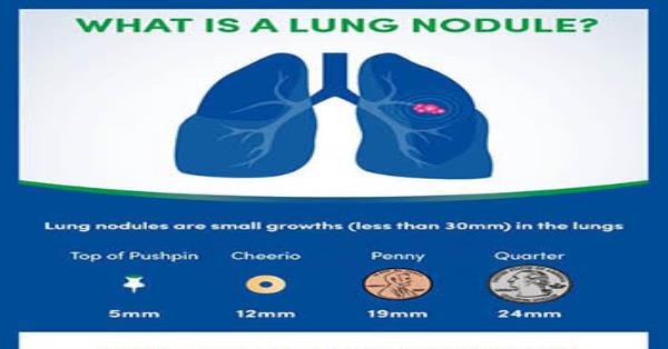 What is a Lung Nodule Infographic Infographics | Medicpresents.com