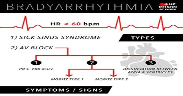 Bradyarrhythmias Infographic Infographics | Medicpresents.com