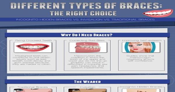 Different Types of Braces Infographic Infographics | Medicpresents.com
