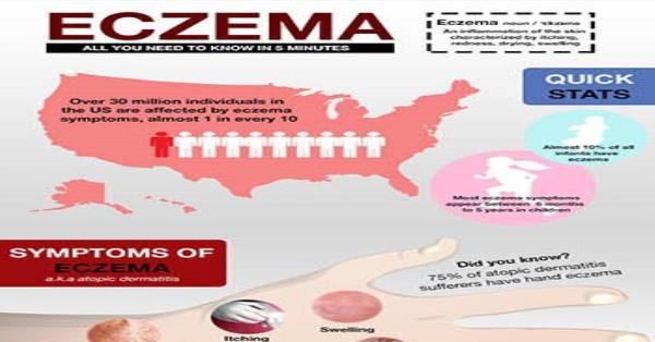 Eczema - All You Need to Know in 5 Minutes Infographic Infographics ...