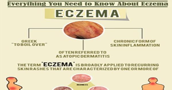 Everything You Need To Know About Eczema Infographic Infographics ...