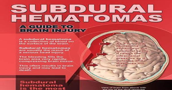 Subdural Hematomas - A Guide to Brain Injury Infographic Infographics ...