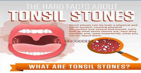 The Hard Facts About Tonsil Stones Infographic