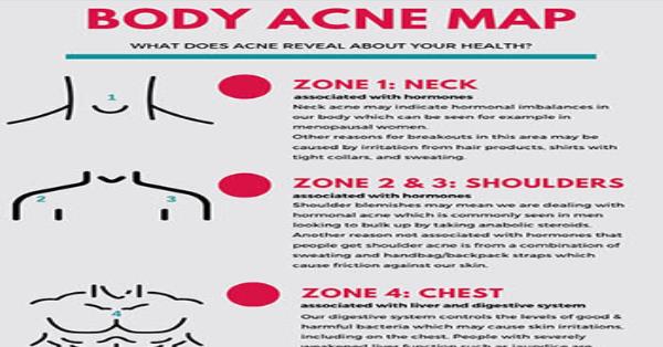 Acne Body Map - What Does Acne Reveal About Your Health Infographic ...