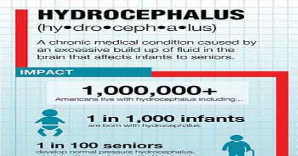 Hydrocephalus Infographic Infographics | Medicpresents.com
