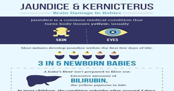 Jaundice and Kernicterus - Brain Damage in Babies Infographic ...