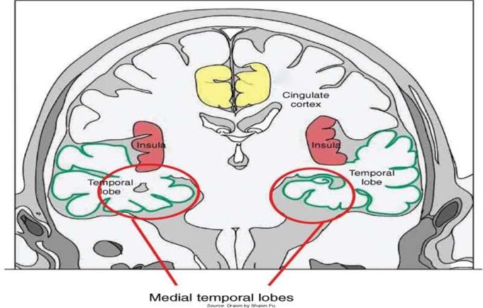 Medial Temporal Gyrus