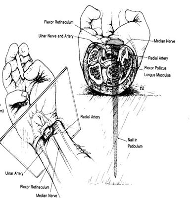Bishops Hand Deformity