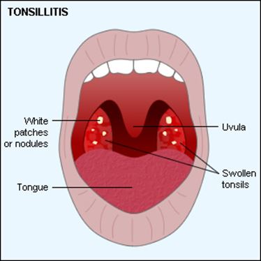 White Spot On Uvula