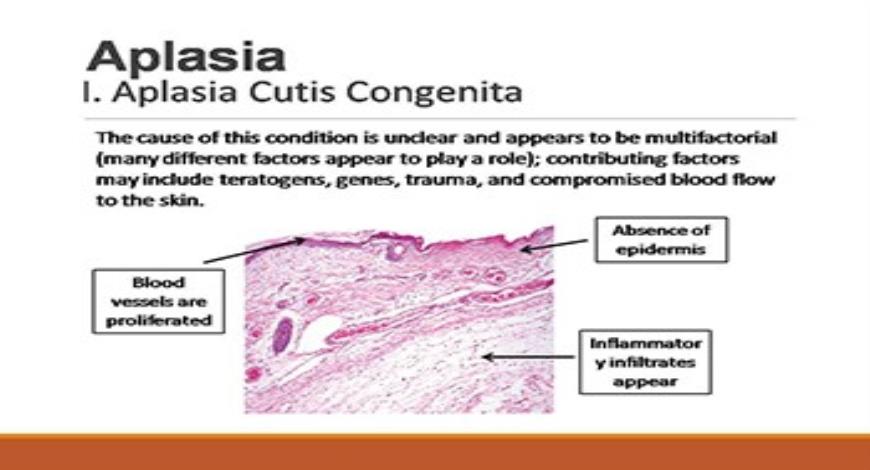 Download Free Medical Aplasia - Abnormalities in Cell Growth PowerPoint ...