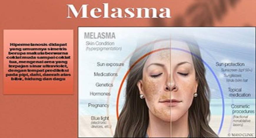 Download Free Medical Melasma PowerPoint Presentation