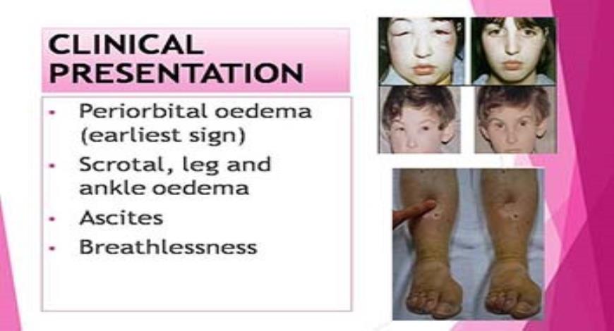 Download Free Medical Nephrotic Syndrome PowerPoint Presentation