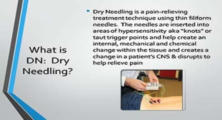 Download Free Medical Dry Needling by Physical Therapists PowerPoint ...
