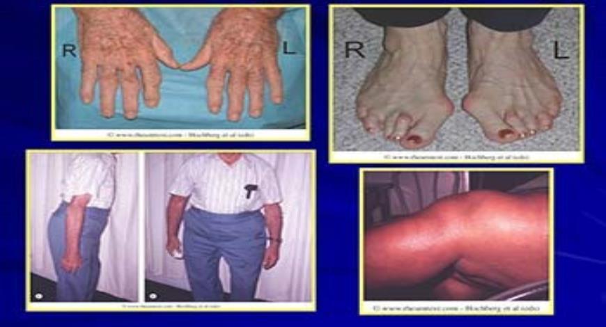 Download Free Medical Rheumatology 101 PowerPoint Presentation