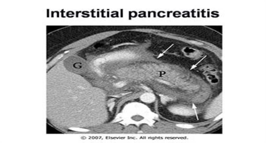 Download Free Medical Acute and Chronic Pancreatitis PowerPoint ...