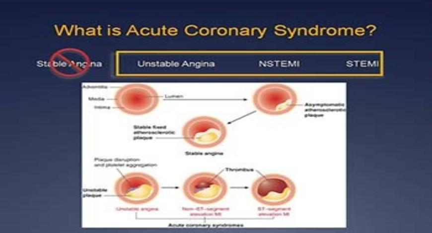 Download Free Medical Acute Coronary Syndrome PowerPoint Presentation