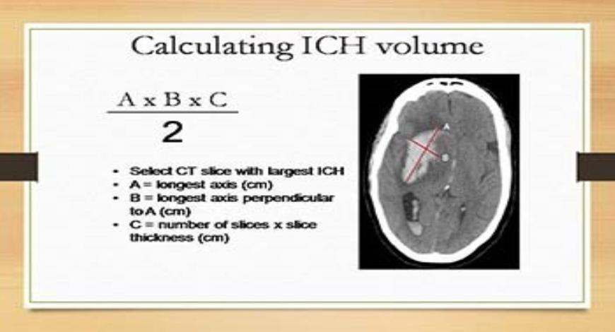 Download Free Medical Intracerebral Hemorrhage (ICH) PowerPoint ...