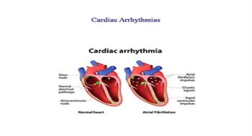 Download Free Medical Cardiac Arrhythmias PowerPoint Presentation