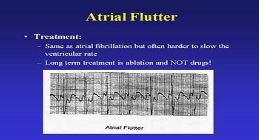 Download Free Medical Supraventricular Tachycardia PowerPoint Presentation