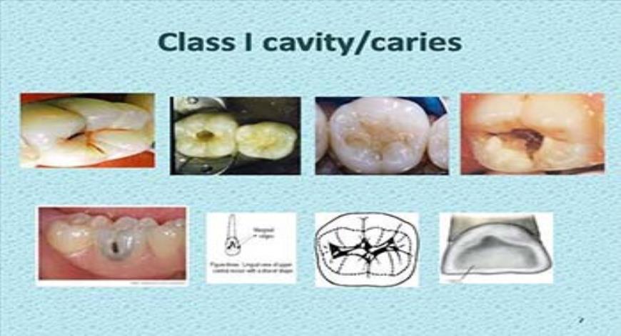 Download Free Medical Classification of cavities PowerPoint Presentation