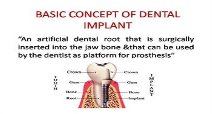 Download Free Medical Basic concept of dental implant PowerPoint Presentation
