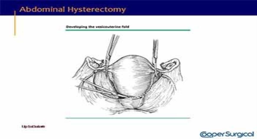 Download Free Medical Hysterectomy PowerPoint Presentation