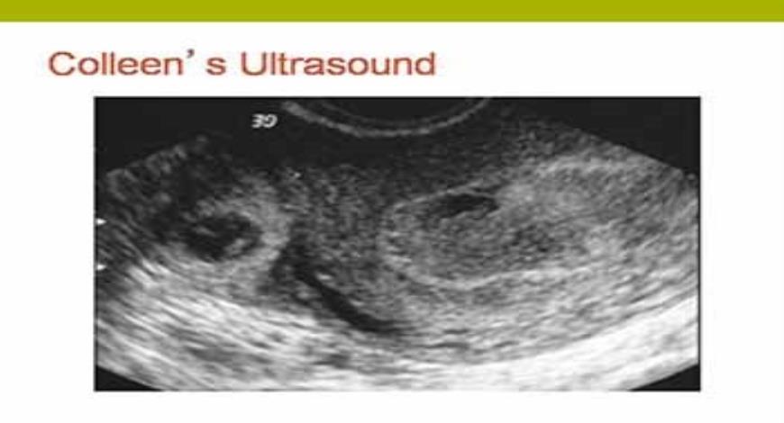 Download Free Medical First Trimester Bleeding PowerPoint Presentation