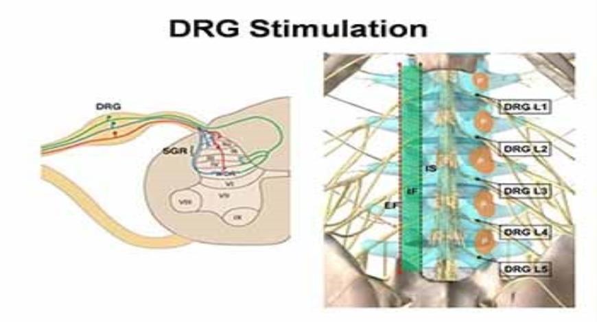 Download Free Medical Spinal Cord and DRG Stimulation PowerPoint ...