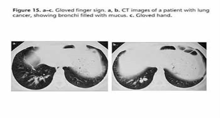 Download Free Medical SIGNS IN CHEST IMAGING PowerPoint Presentation