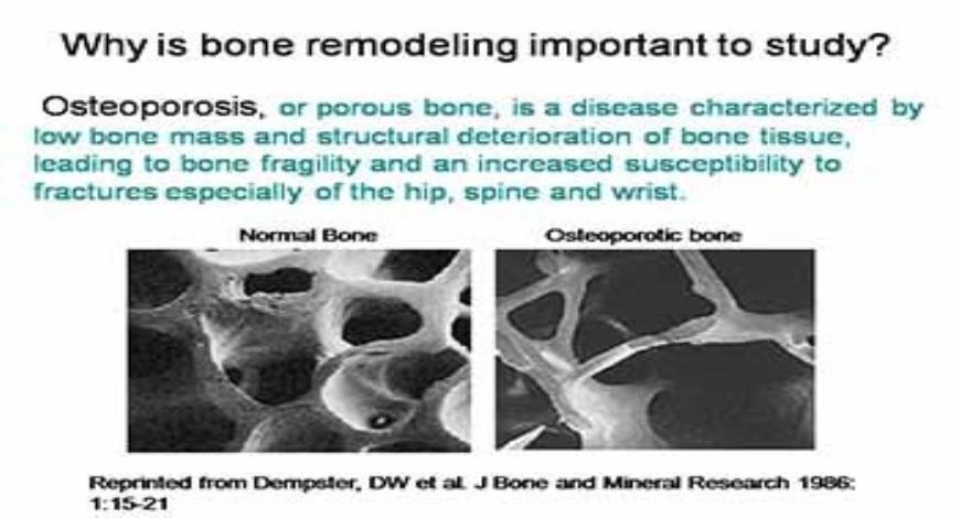 Download Free Medical Physiology of Bone Remodeling Outcomes PowerPoint ...