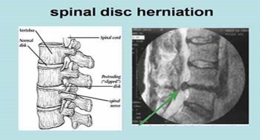 Download Free Medical Disorders and Abnormal Curvatures of Spinal ...