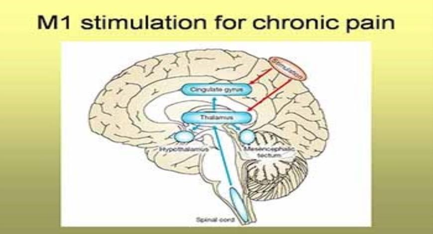 Download Free Medical Neuromodulation for chronic pain PowerPoint ...