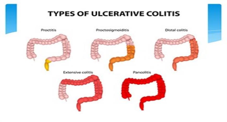 Download Free Medical Ulcerative Colitis PowerPoint Presentation