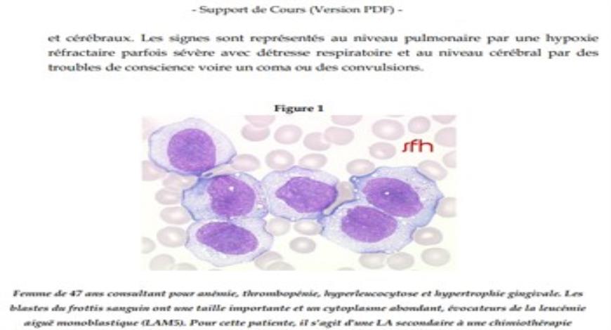 Download Medical Notes on Leucemies Aigues