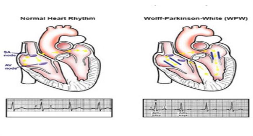 Download Medical Notes on Wolf Parkinson White Syndrome