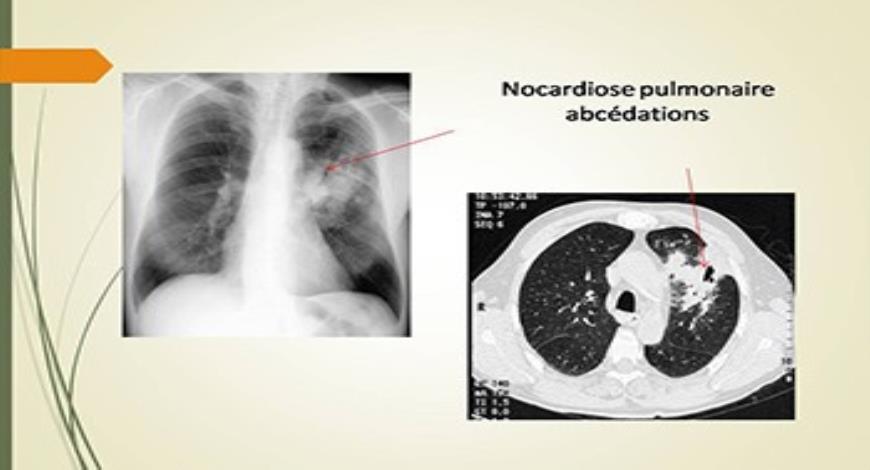 Download Free Medical Pneumopathie Infectieuses et Immunodepressions ...
