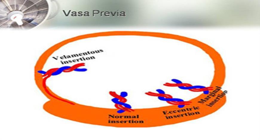 Download Free Medical Vasa Previa Green Top Guidelines PowerPoint ...