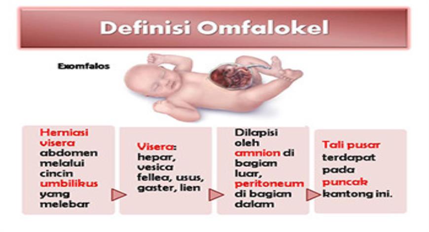 Download Free Medical Omphalocele PowerPoint Presentation