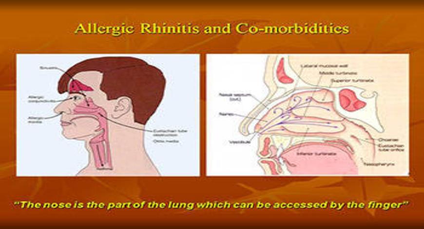 Download Free Medical Allergic Rhinitis and co-morbidities in children ...