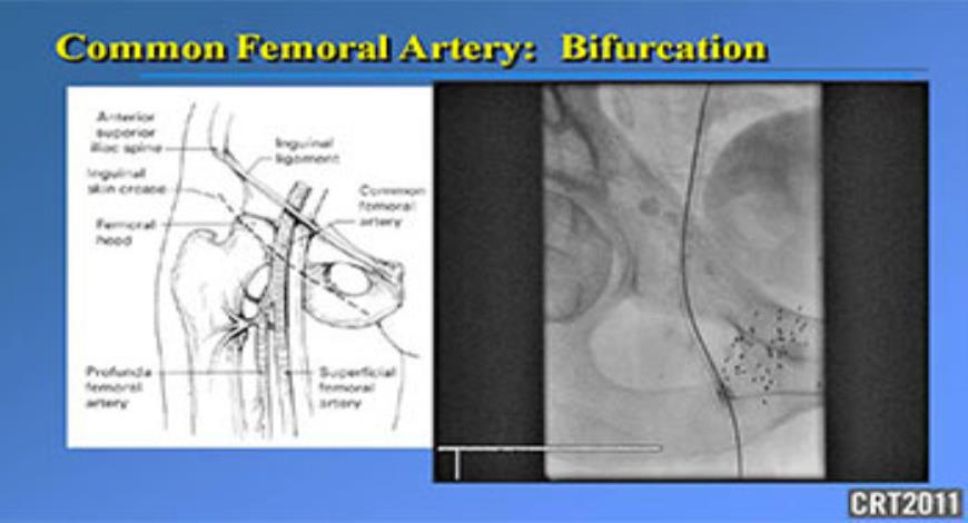 Download Free Medical Vascular Access and Vascular Closure Devices ...