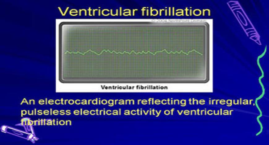 Download Free Medical Arrhythmia PowerPoint Presentation