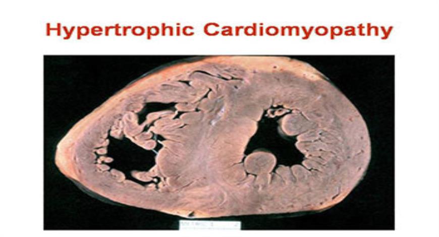 Download Free Medical Hypertrophic Cardiomyopathy PowerPoint Presentation