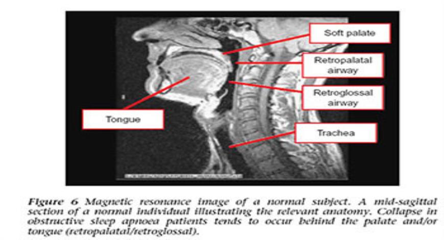 Download Free Medical Obstructive Sleep Apnea Syndrome PowerPoint ...