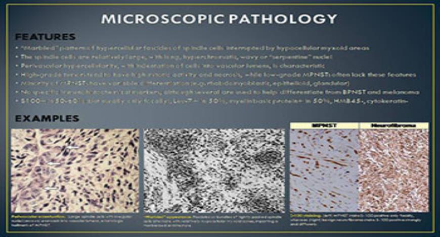Download Free Medical Malignant Peripheral Nerves Heath Tumors-MPNST ...