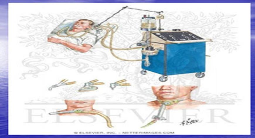 Download Free Medical Mechanical Ventilation PowerPoint Presentation