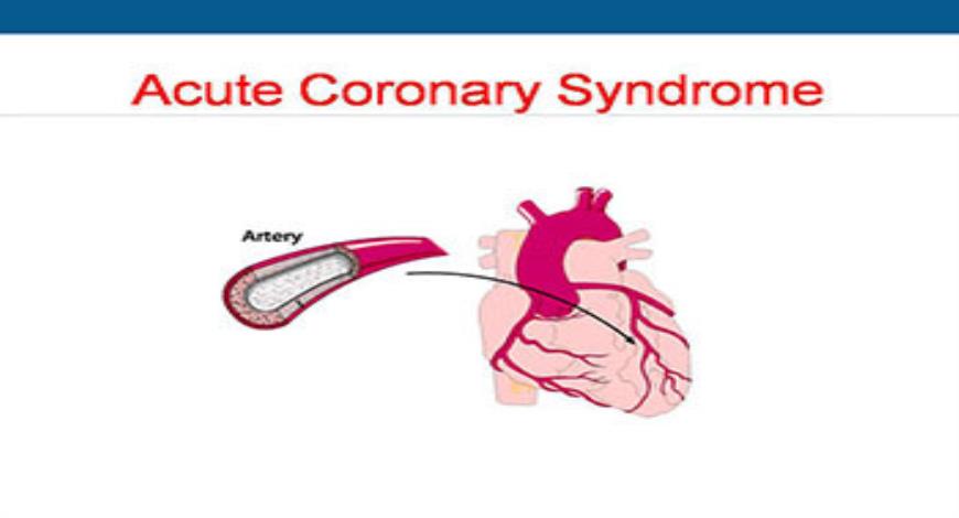 Download Free Medical Acute Coronary Syndrome PowerPoint Presentation