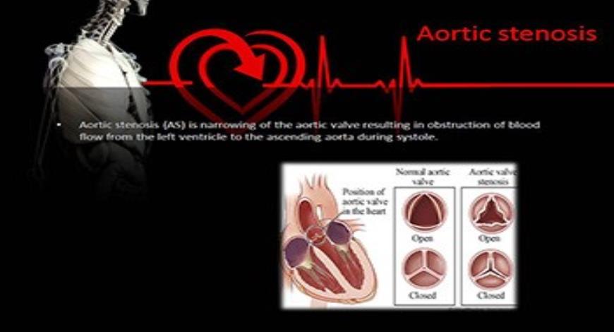 Aortic stenosis Medical Presentation