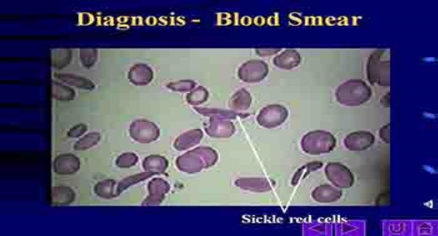 Download Free Medical What is Sickle Cell Disease PowerPoint Presentation