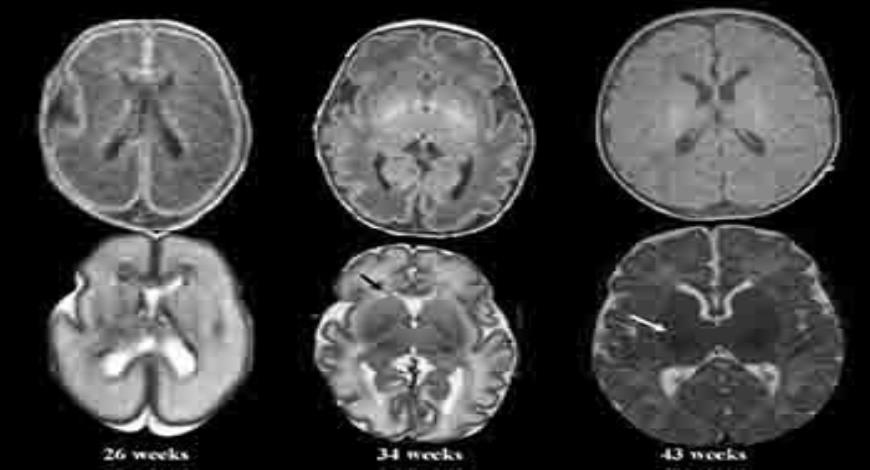 Download Free Medical Late Preterm and Early Term Infants PowerPoint ...