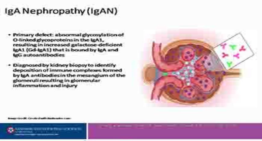Download Free Medical Iga Nephropathy-Igan PowerPoint Presentation